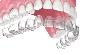Invisible orthodontic braces : Important Tips Before You Start