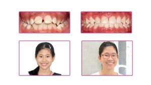 Braces change your face shape: Before and after braces photos