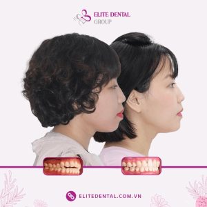 Braces change your face shape: Before and after braces photos