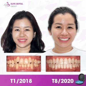 Braces change your face shape: Before and after braces photos