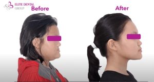 Braces change your face shape: Before and after braces photos