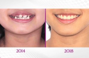 Braces change your face shape: Before and after braces photos