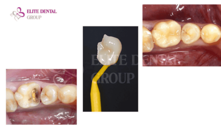 What's Dental Root Filling Procedure And Recovery Process?
