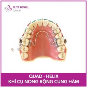 Khí cụ Quad - Helix: Hỗ trợ nong (nới) rộng hàm cho trẻ