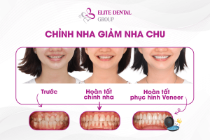 Khớp cắn chéo là gì? Đặc điểm, nguyên nhân và cách điều trị